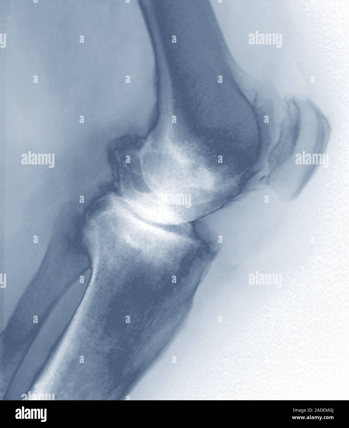 Osteoarthritis of the knee. Coloured X-ray of a section through the ...