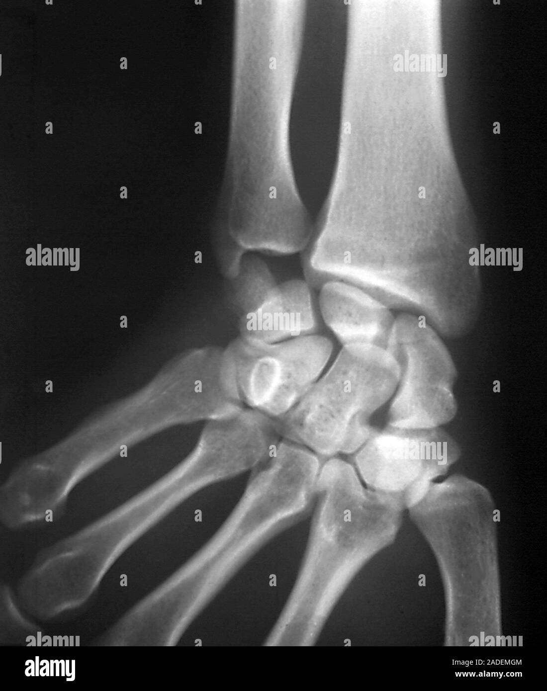 Broken wrist. X-ray of a section through the wrist of a 22-year-old ...
