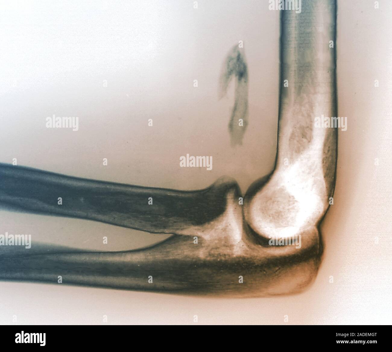 Osteoma. Coloured X-ray of a section through the elbow of a sports ...