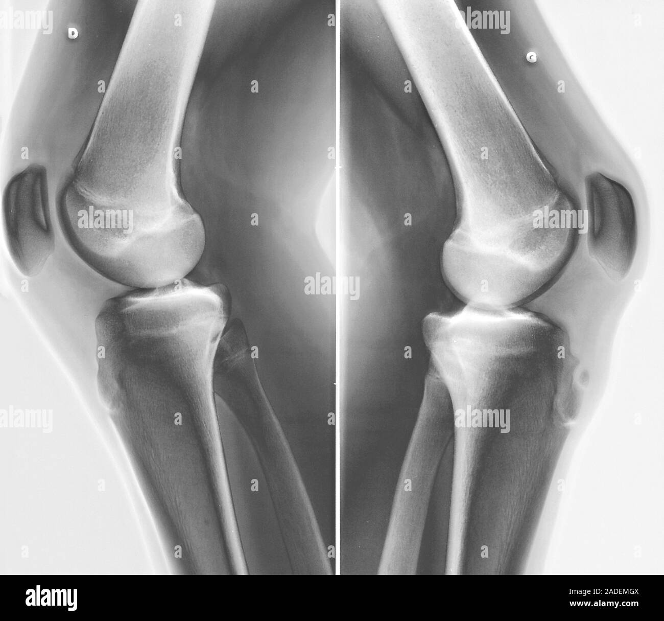 Osgood-Schlatter disease. X-rays of the knees of a 15-year-old patient ...