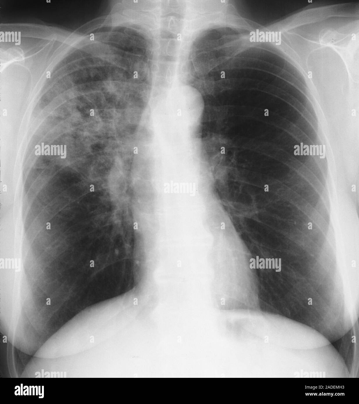 Pneumonia. Frontal chest X-ray of a 60-year-old patient, showing a ...