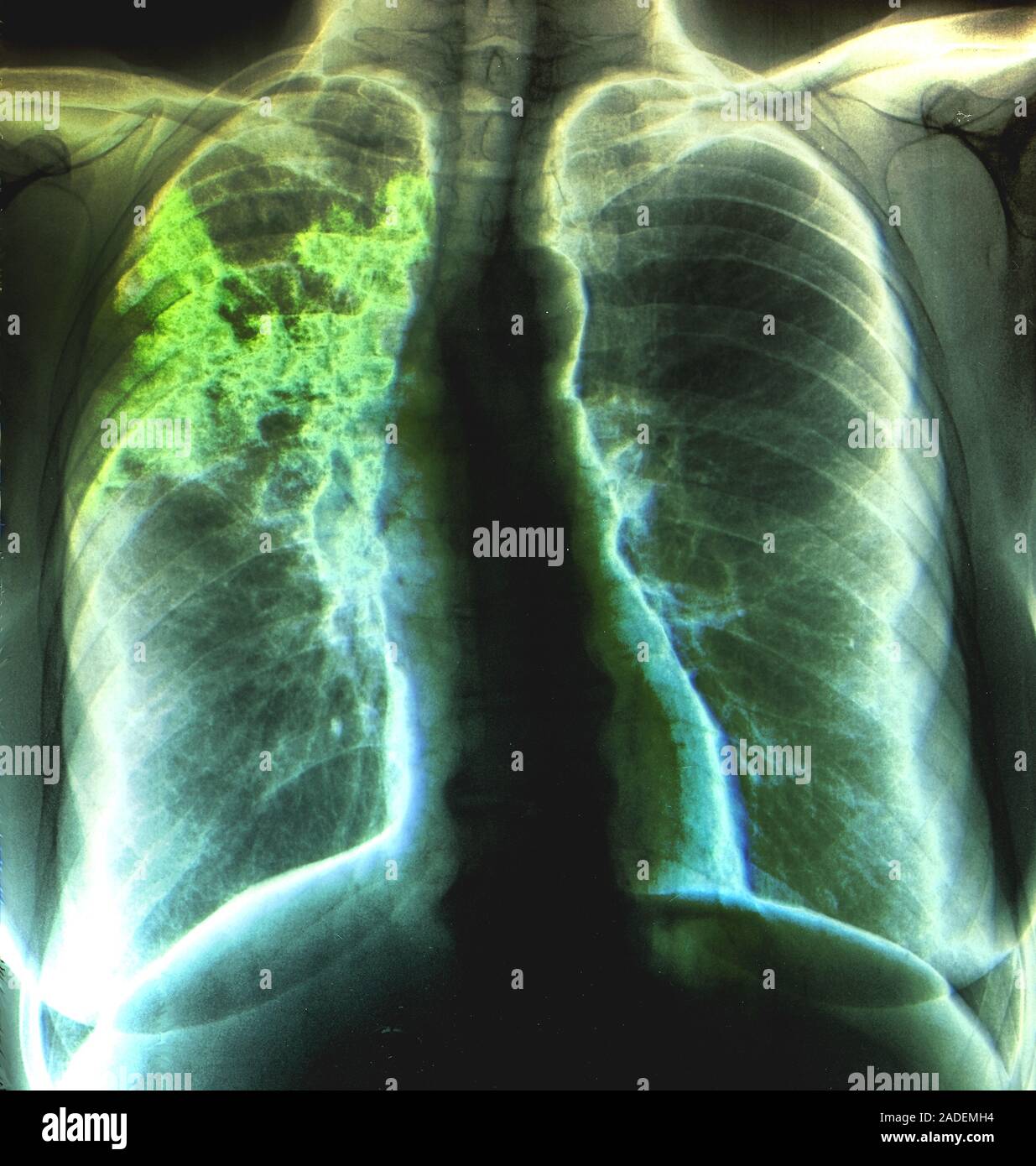 Pneumonia. Frontal chest X-ray of a 60-year-old patient, showing a ...