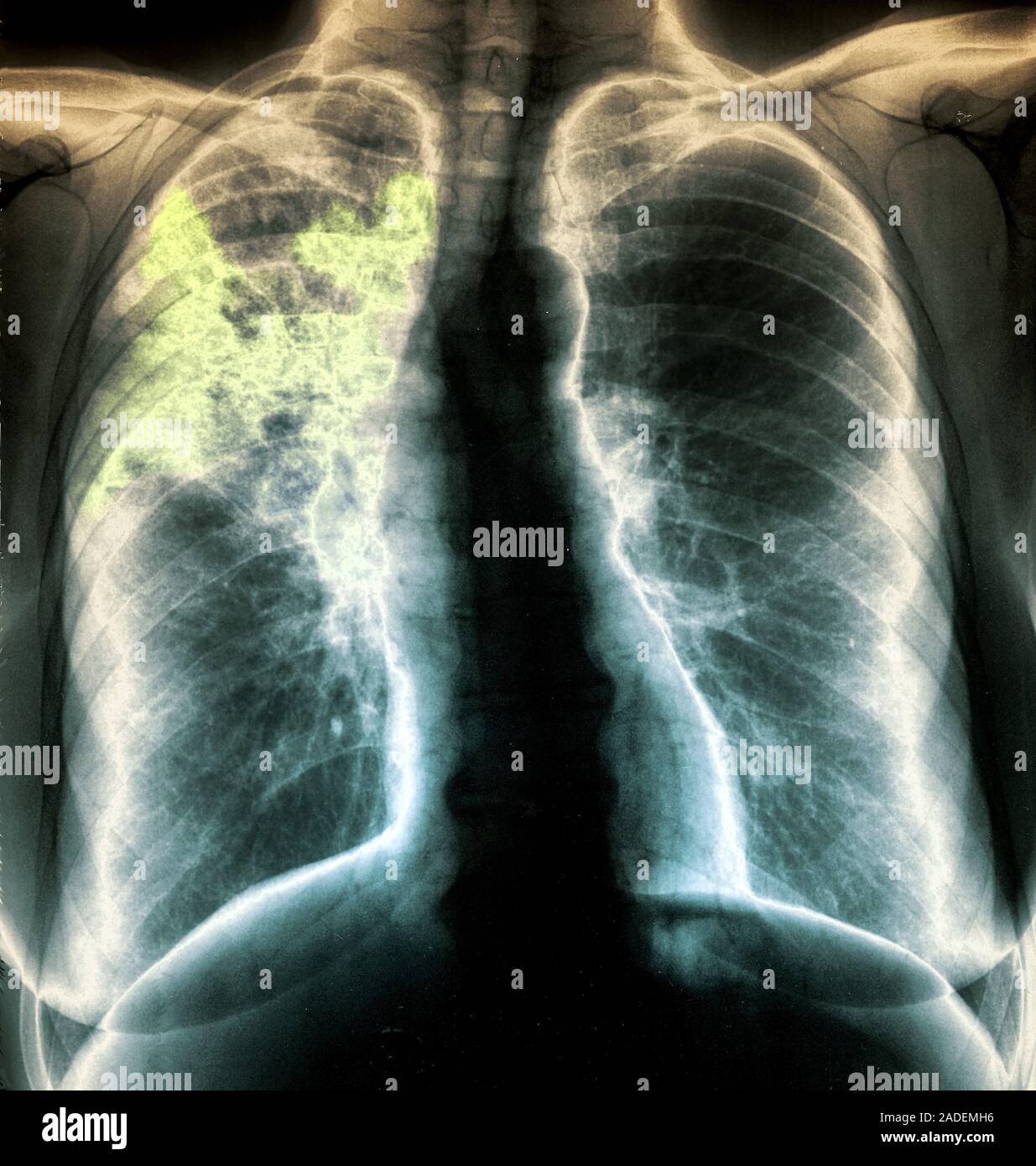 Pneumonia. Frontal chest X-ray of a 60-year-old patient, showing a ...
