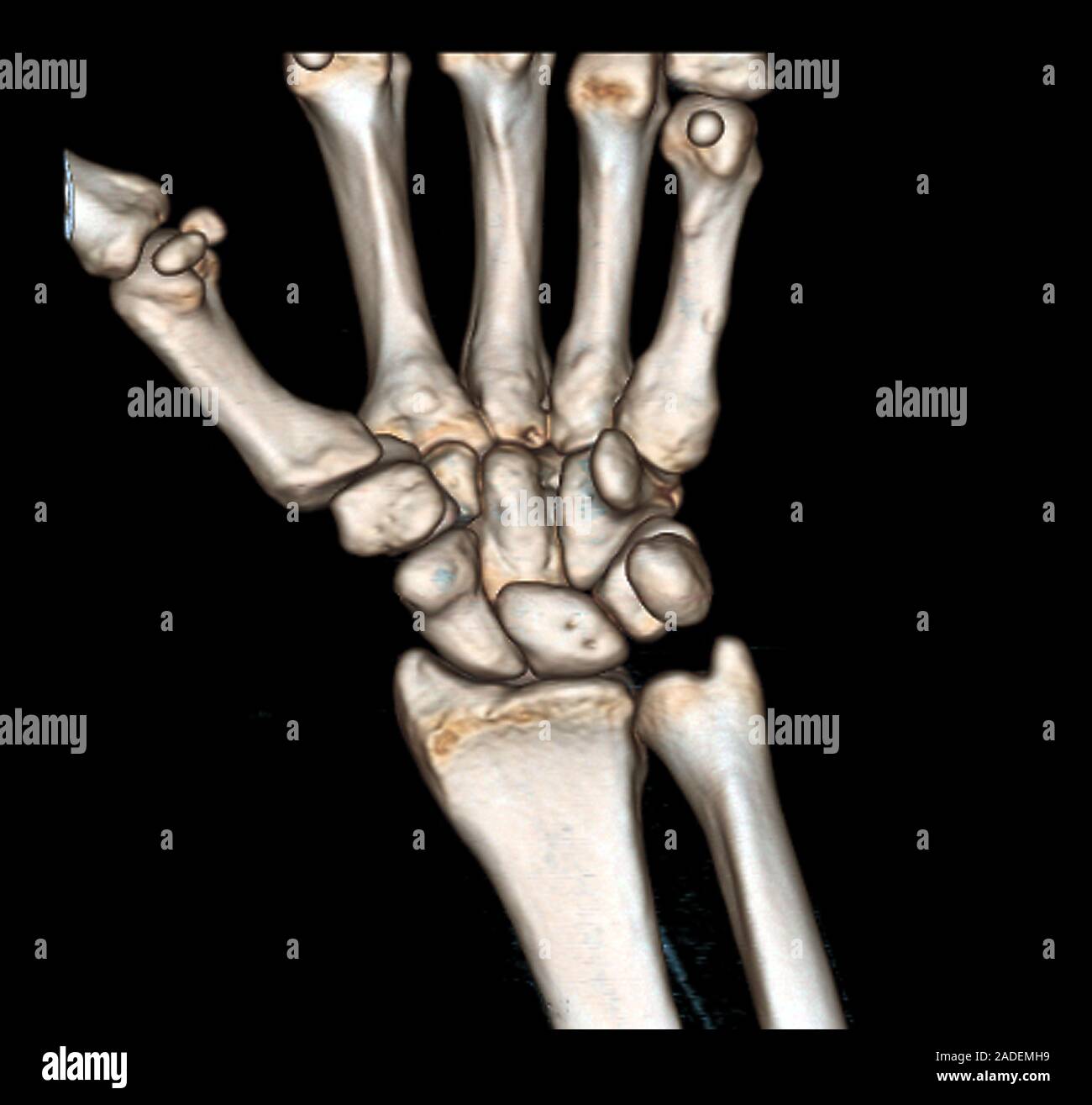 Normal wrist. 3-dimensional computed tomography (CT) scan of the ...