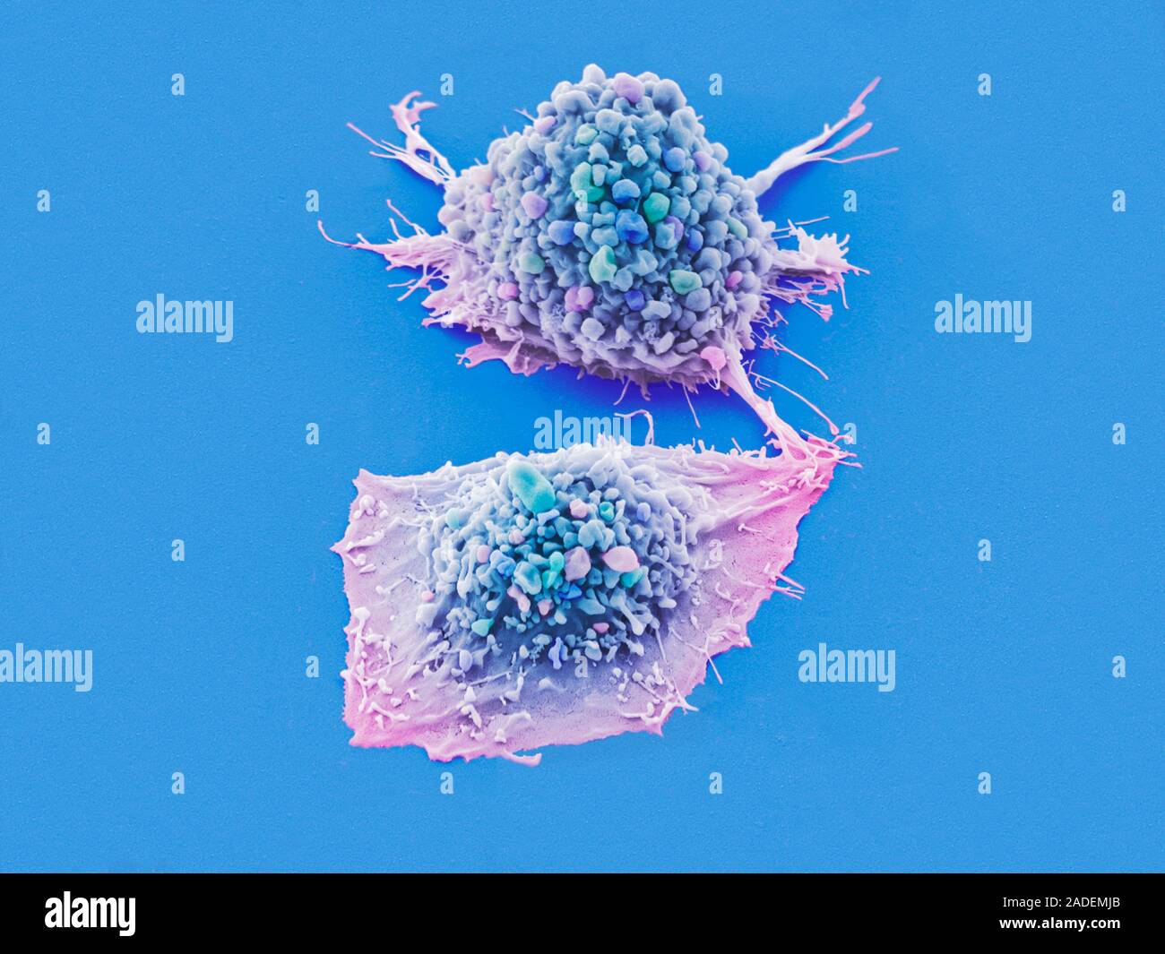 Images not to be used by the tobacco industry. Lung cancer cells with ...