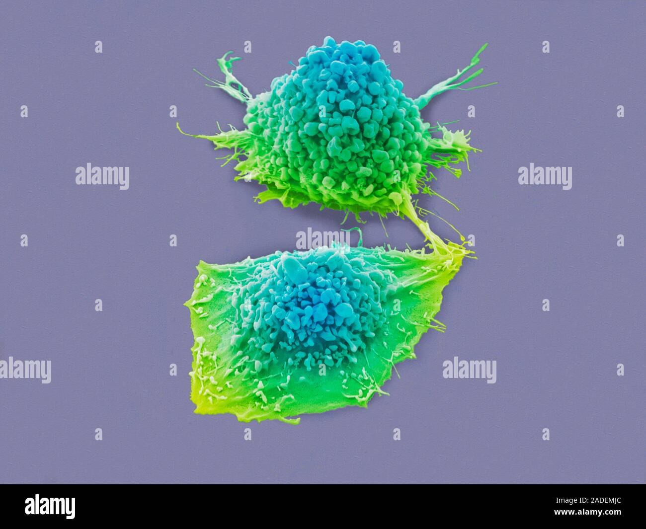 Images not to be used by the tobacco industry. Lung cancer cells with ...