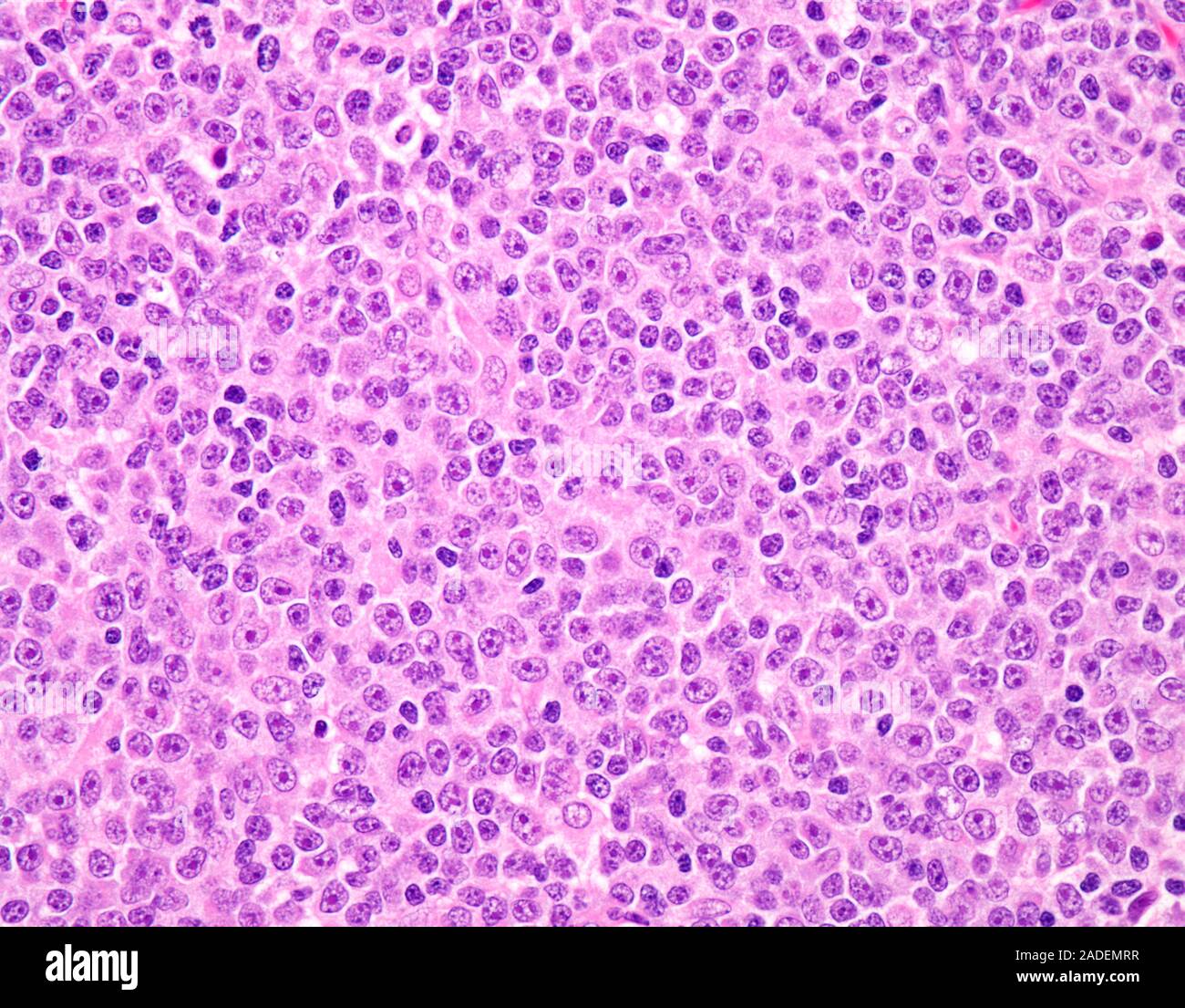 Light micrograph of follicular lymphoma, high-grade (grade 3b). Grade 3 ...