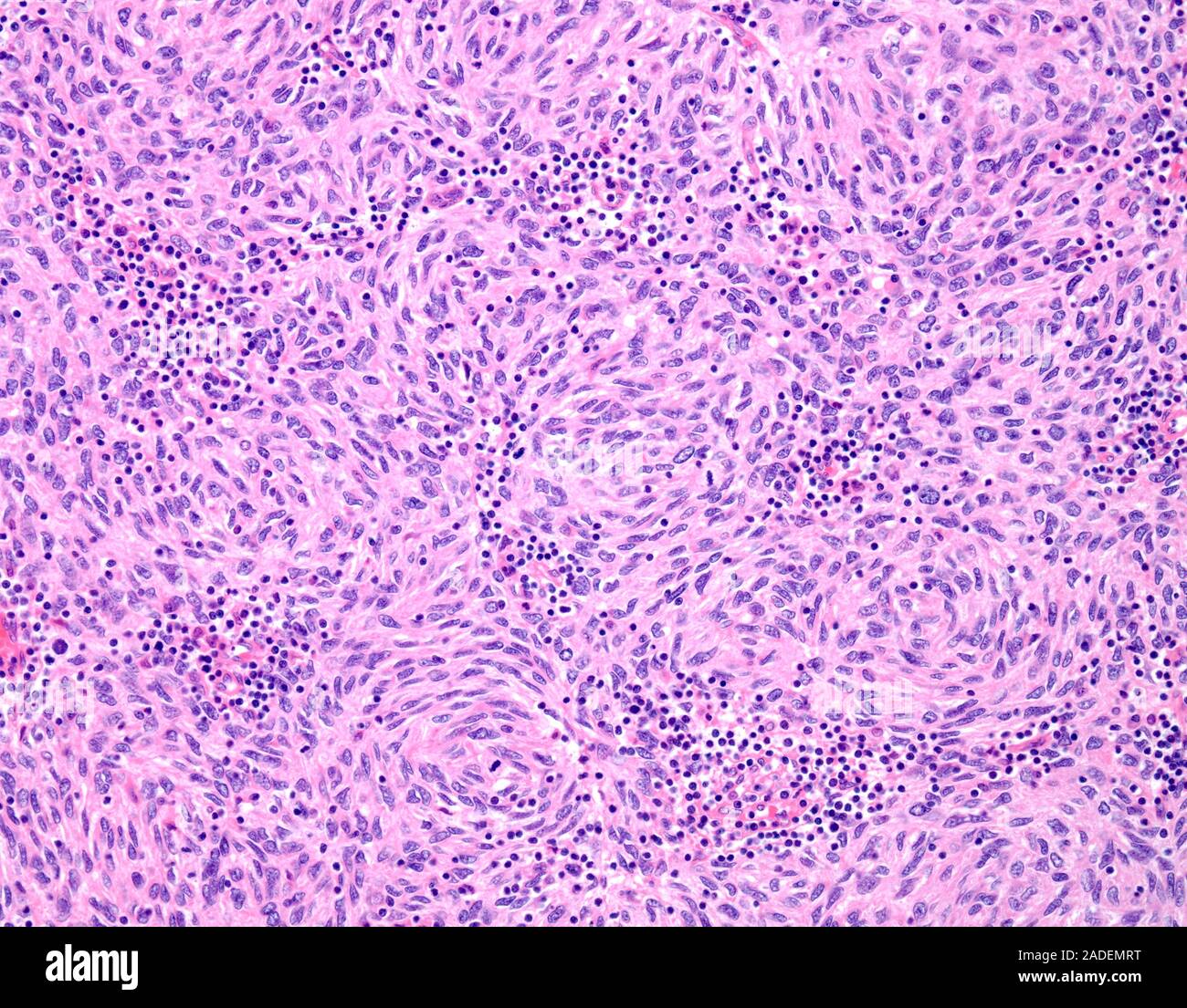 Follicular dendritic cell sarcoma, light micrograph. The tumour is ...