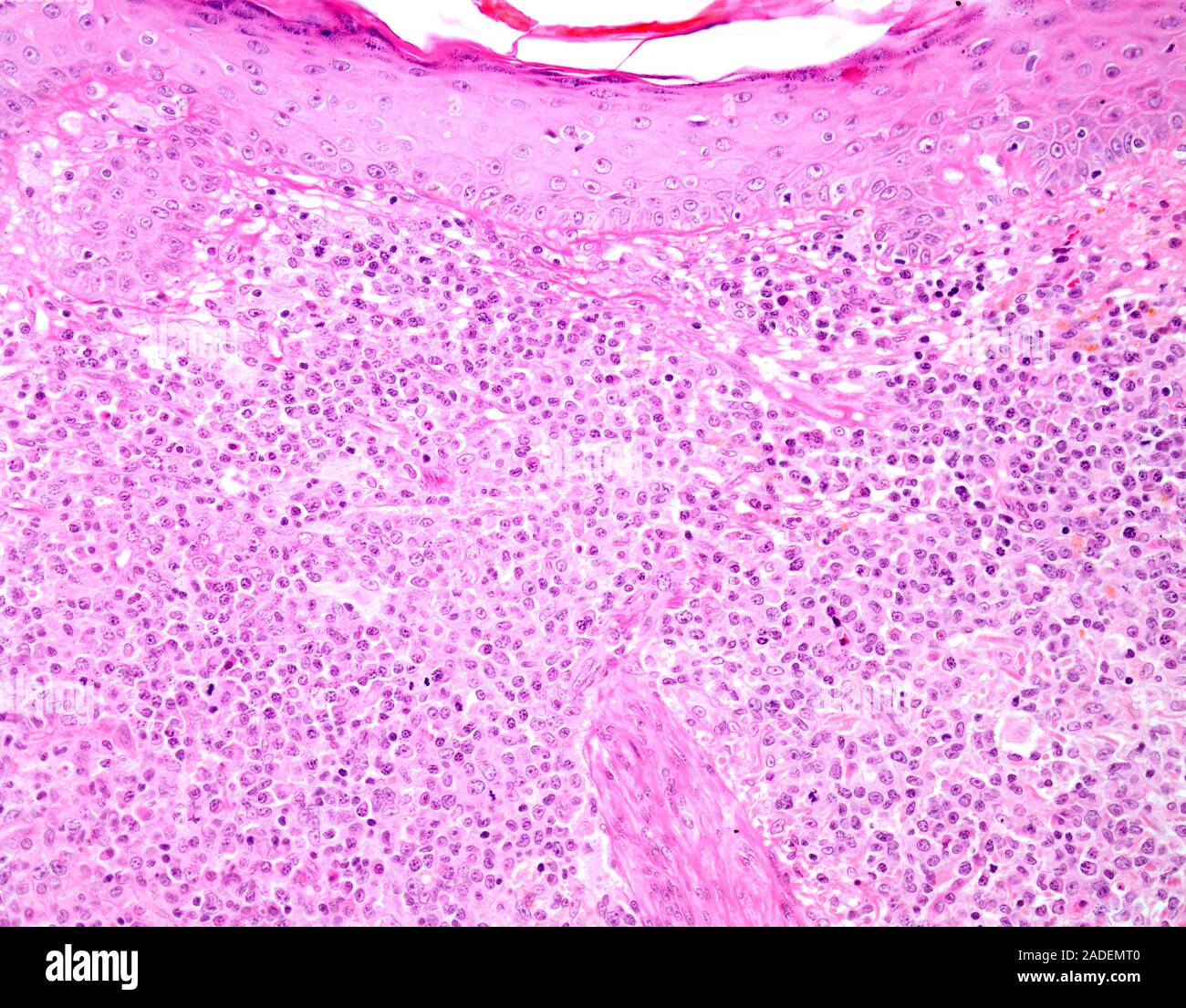 Myeloid sarcoma. Light micrograph of a diffuse leukemic infiltrate in ...
