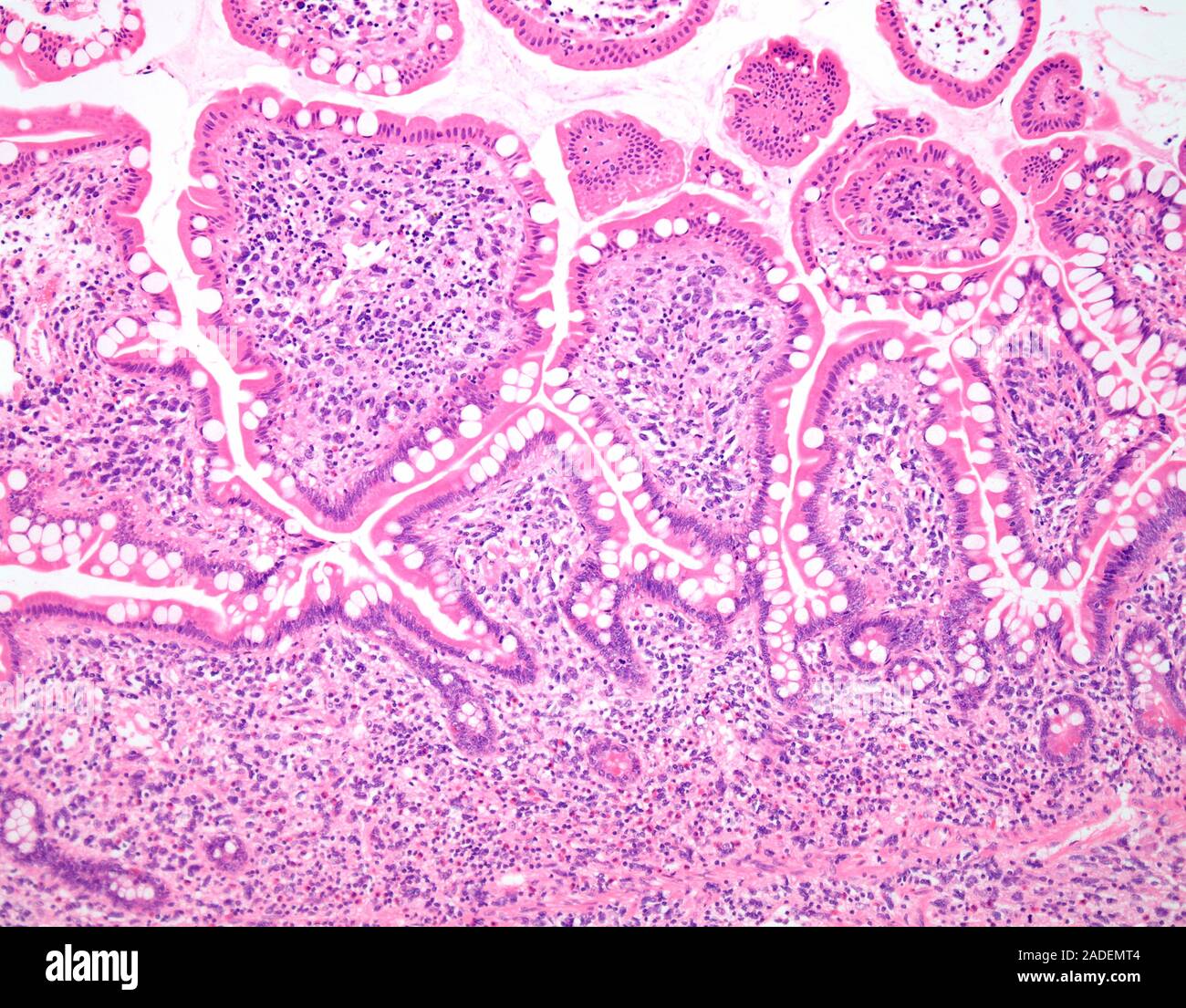 Light micrograph showing a histiocytic sarcoma of the small bowel that ...