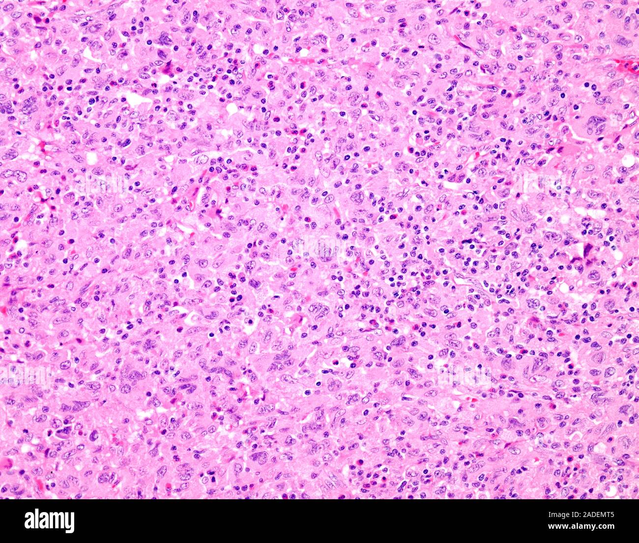 Hairy cell leukaemia, light micrograph. Histiocytic sarcoma is a ...
