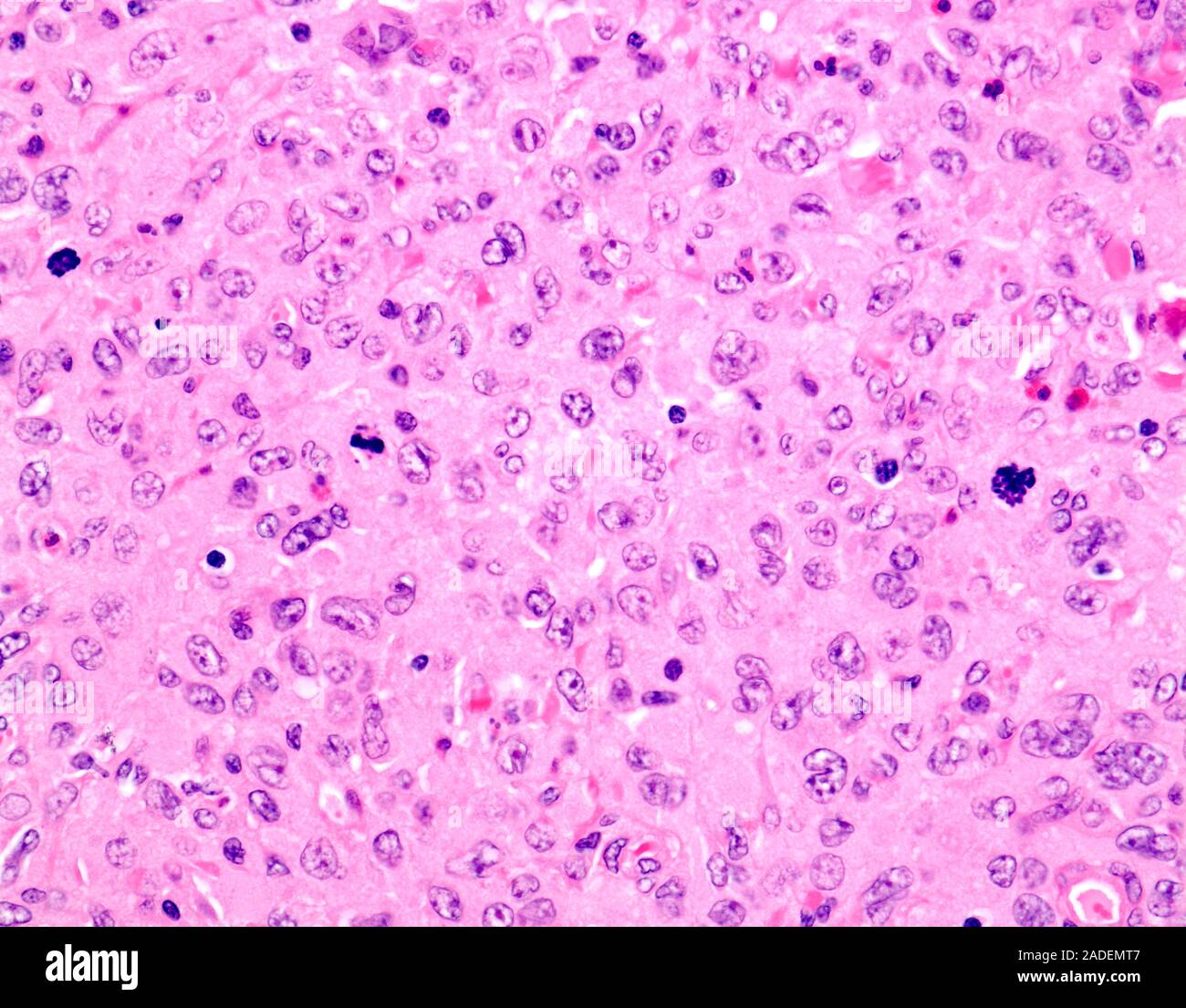 Hairy cell leukaemia, light micrograph. Histiocytic sarcoma is a ... Hairy cell leukaemia, light micrograph. Histiocytic sarcoma is a ...