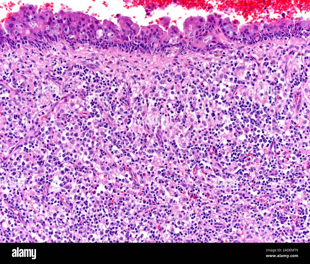 NK/T-cell lymphoma, light micrograph. NK/T-cell neoplasms are almost ...