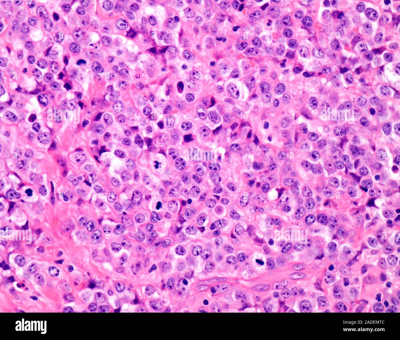 Plasmablastic lymphoma, light micrograph. Plasmablastic lymphoma is a variant of diffuse large B ...