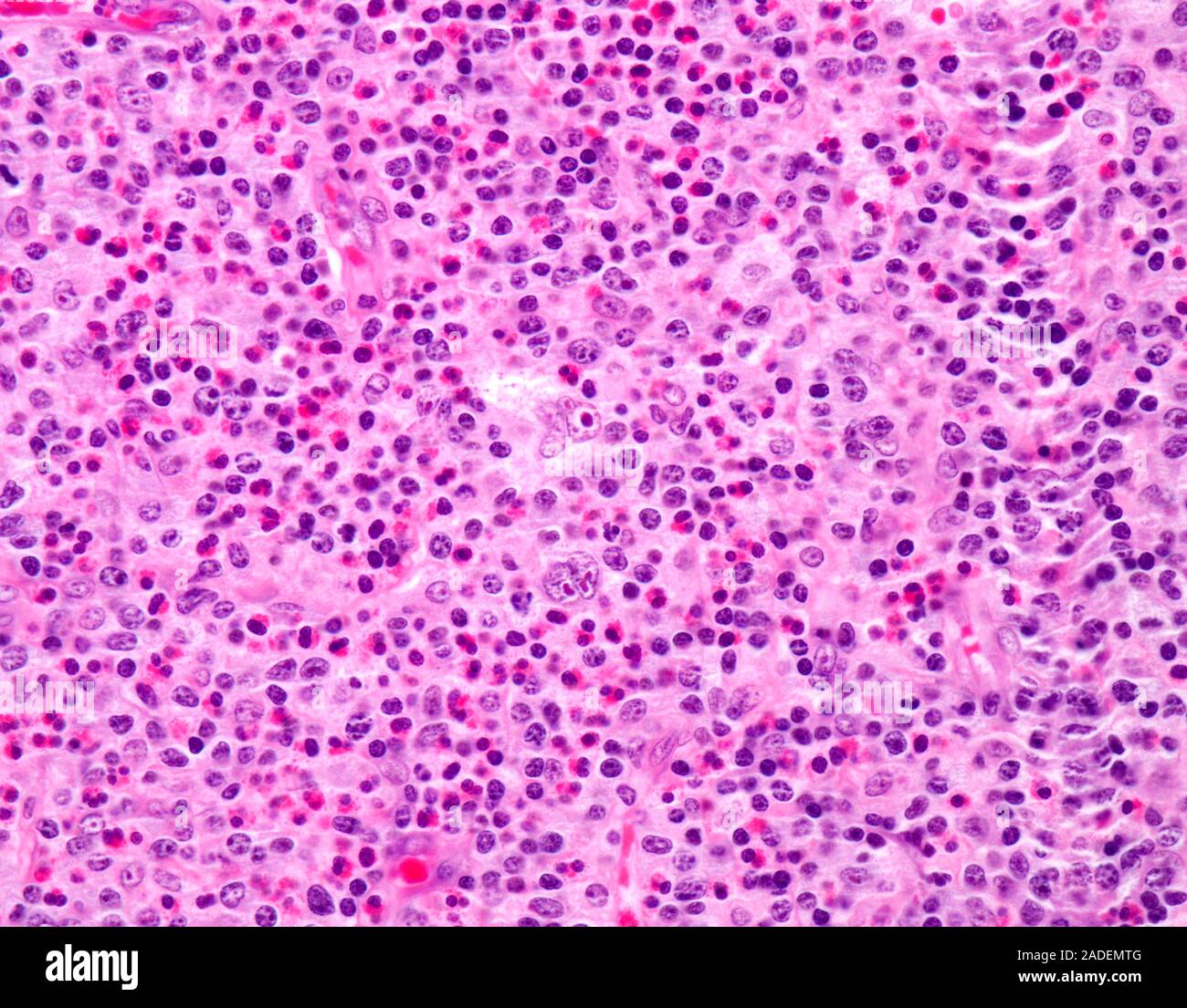 Peripheral T Cell Lymphoma Light Micrograph Some Cases Of Peripheral
