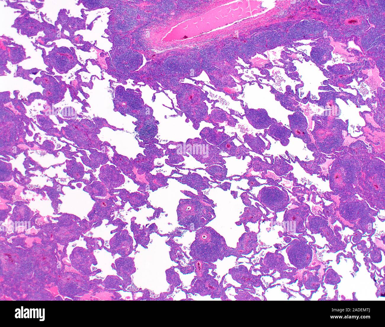 Light micrograph of small lymphocytic lymphoma involving the lungs. The ...