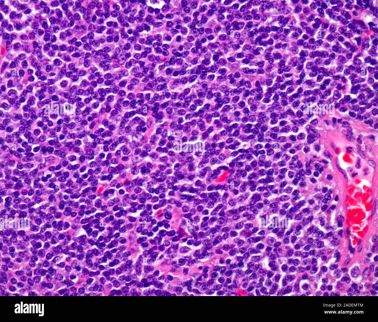 Light micrograph of a case of small lymphocytic lymphoma involving the ...