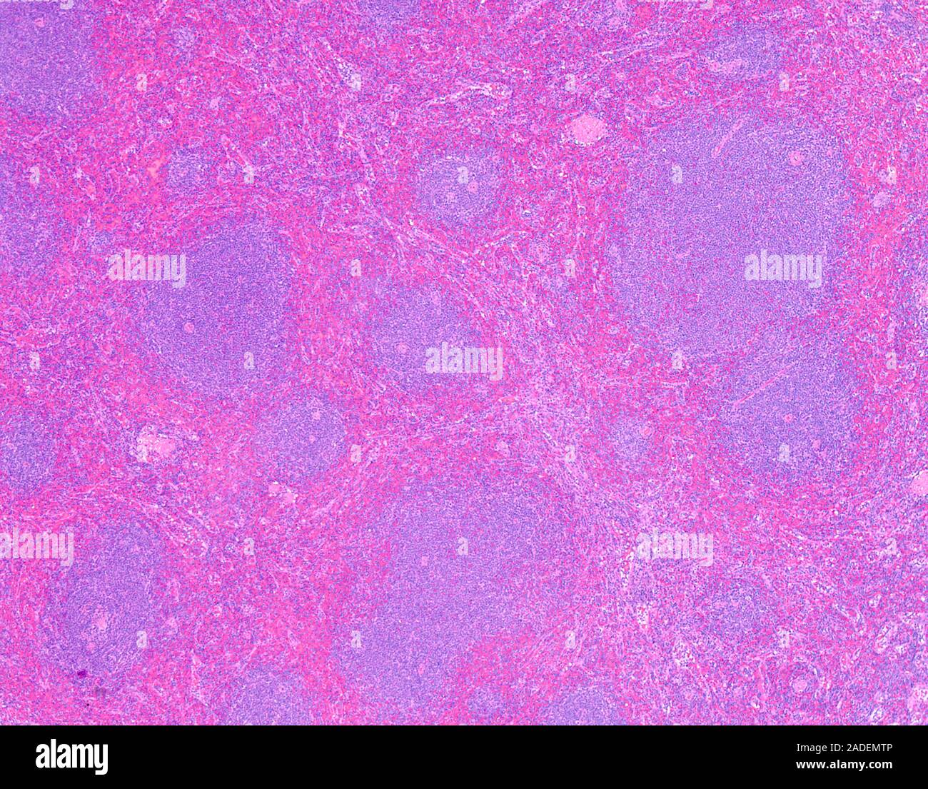 Splenic marginal zone lymphoma, light micrograph. Splenic marginal zone ...