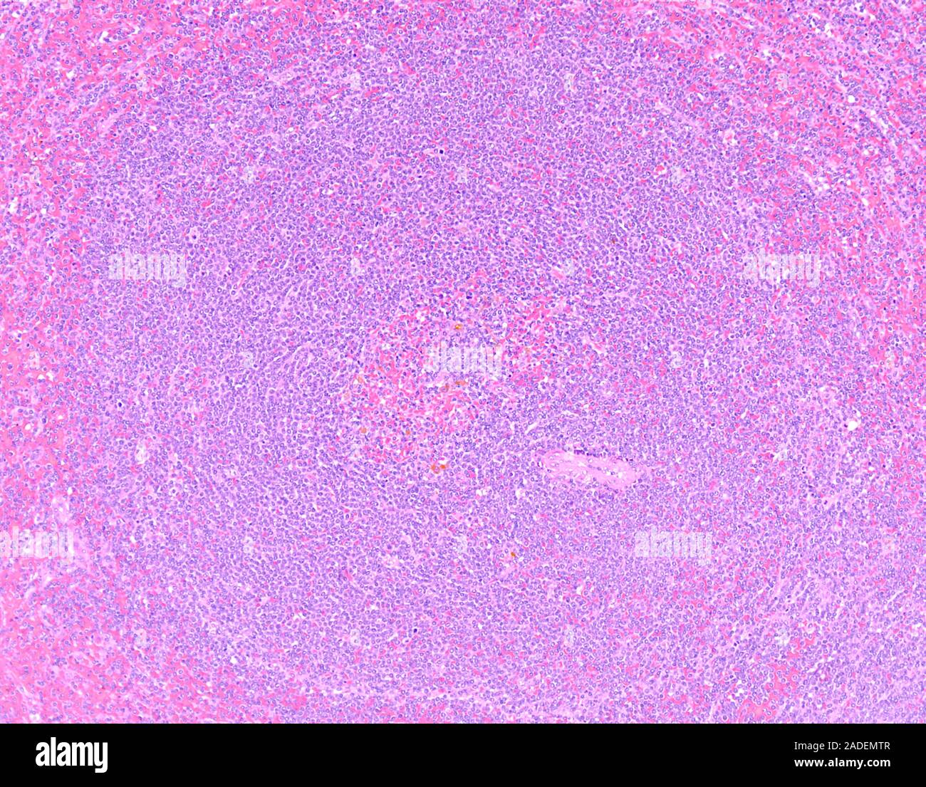 Splenic marginal zone lymphoma, light micrograph. Splenic marginal zone ...