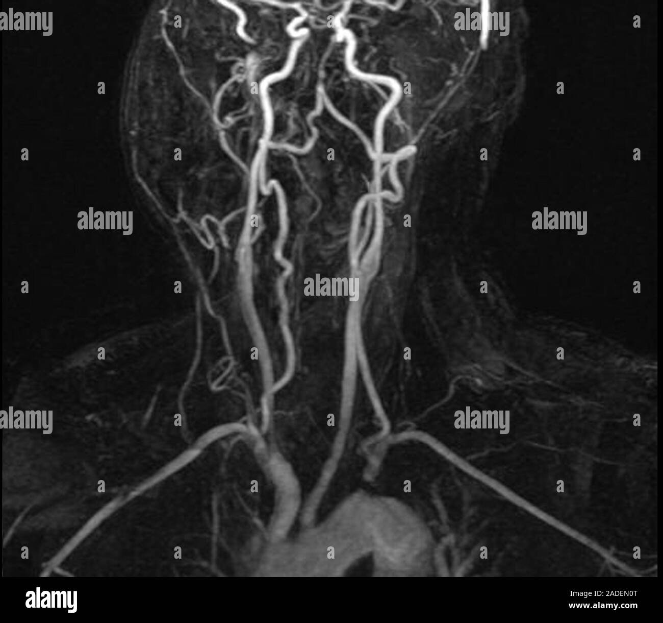Cervico-encephalic magnetic resonance angiogram (MRA) scan of a 60-year ...