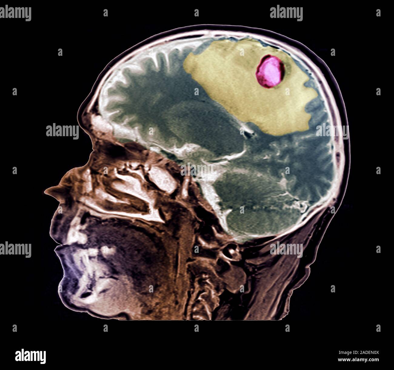 Secondary brain cancer. Coloured coronal magnetic resonance imaging (MRI) scan through the brain ...
