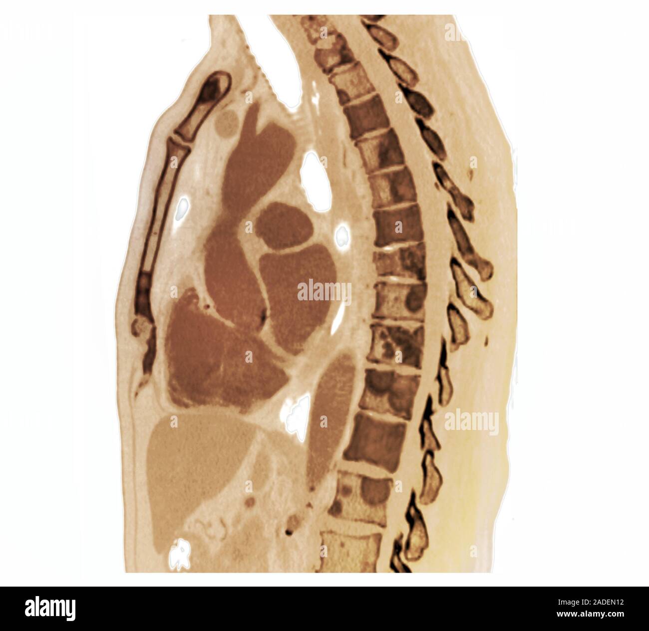 Secondary bone cancer in the spine. Coloured 2D computerised tomography ...