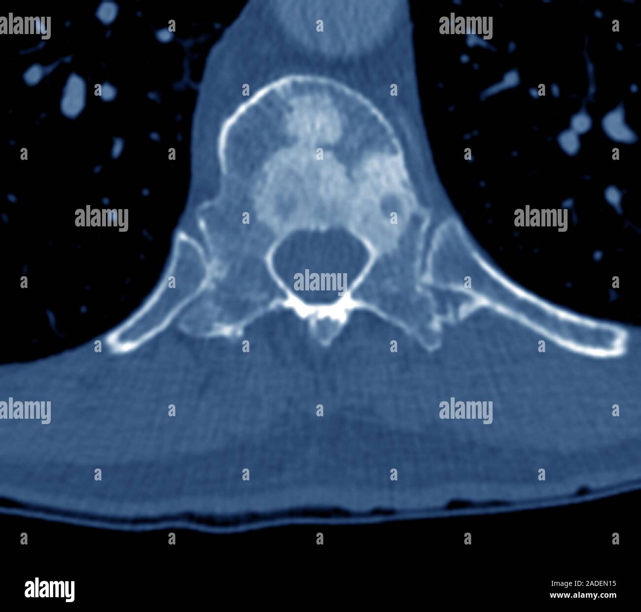 Secondary bone cancer in the spine. 2D coloured computerised tomography ...