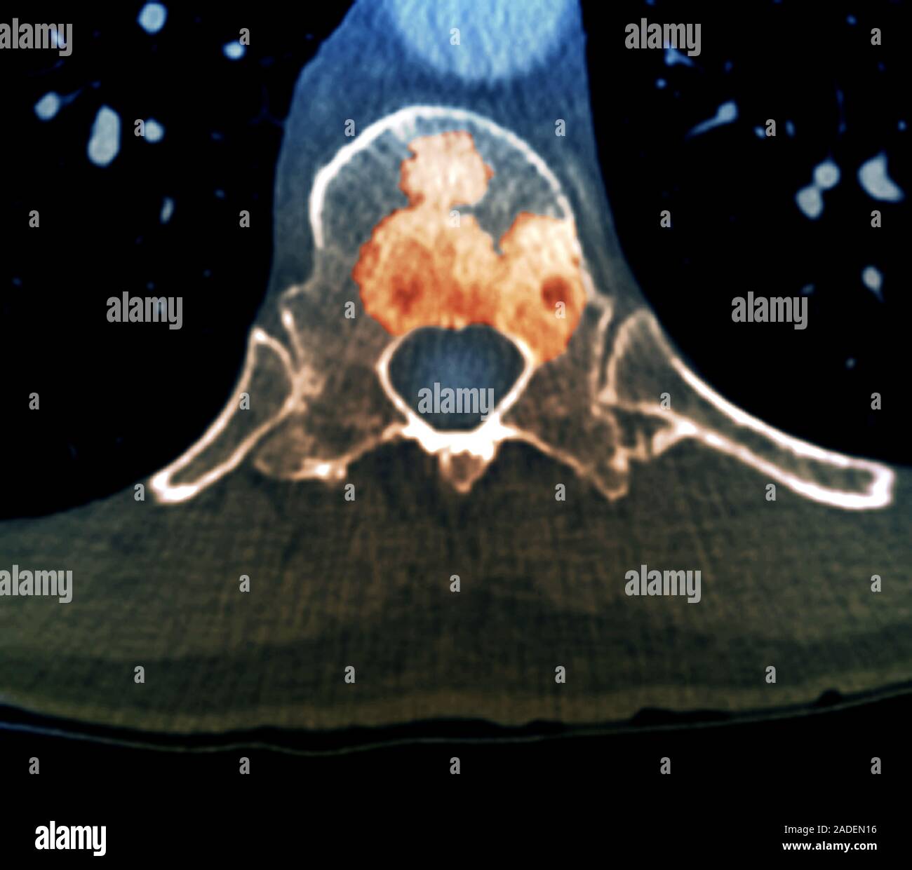 Secondary bone cancer in the spine. 2D coloured computerised tomography ...