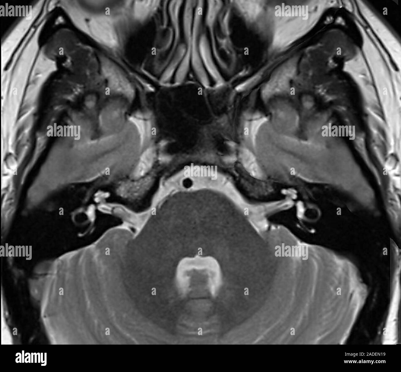 Axial section of the brain and inner ear. T2-weighted magnetic resonance imaging (MRI) scan of ...