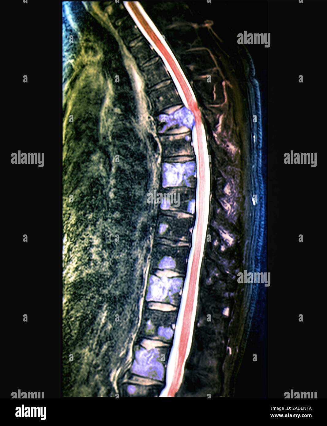 Secondary bone cancer in the spine. Magnetic resonance imaging (MRI ...