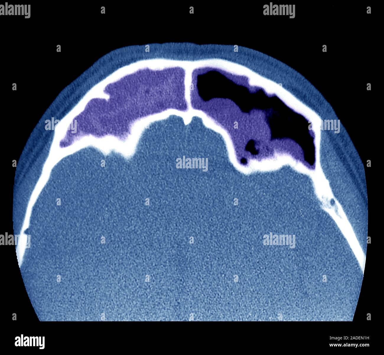 Frontal sinus infection. Coloured computerized tomography (CT) scan of ...
