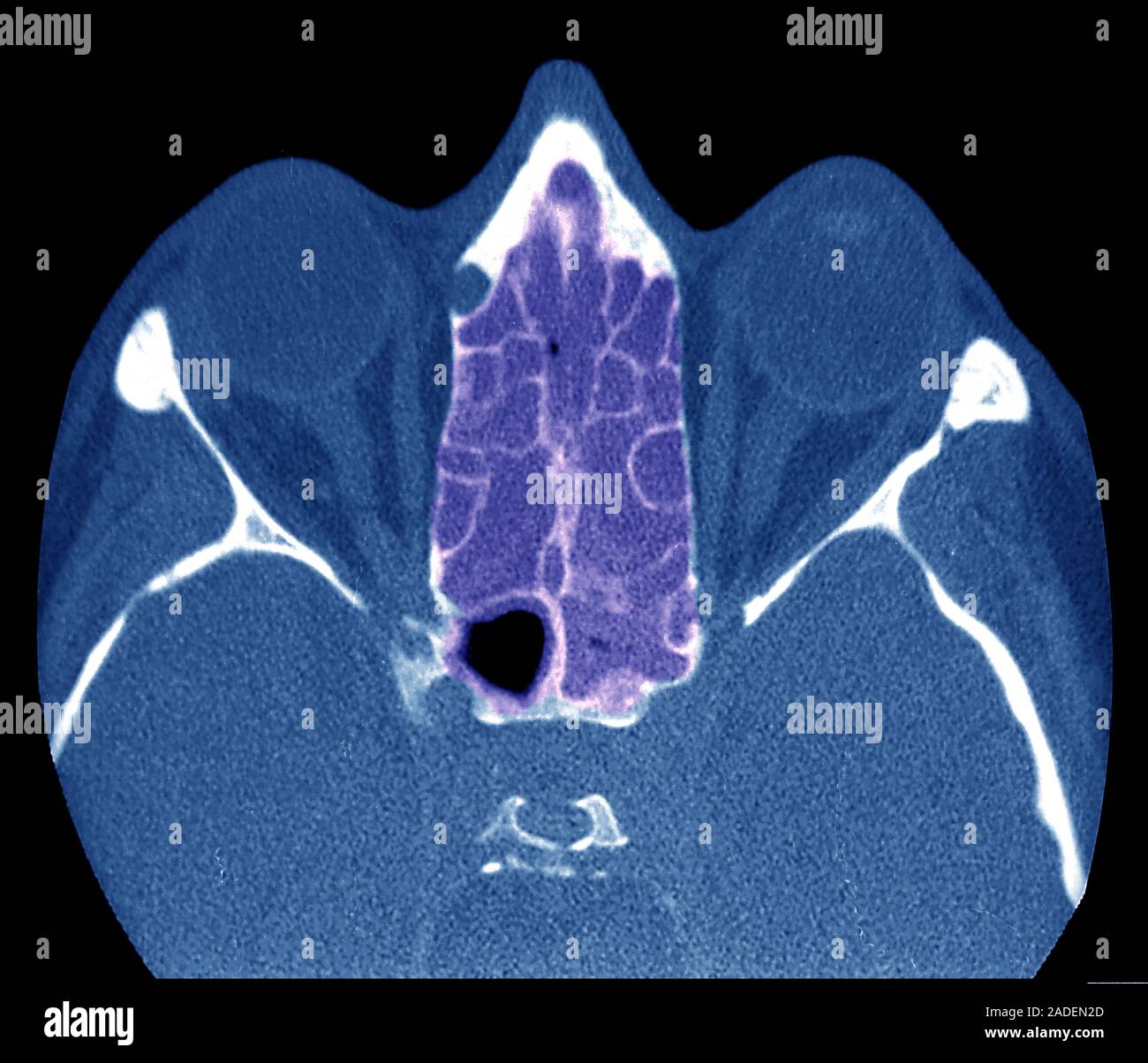Ethmoid sinus infection. Coloured computerized tomography (CT) scan of ...