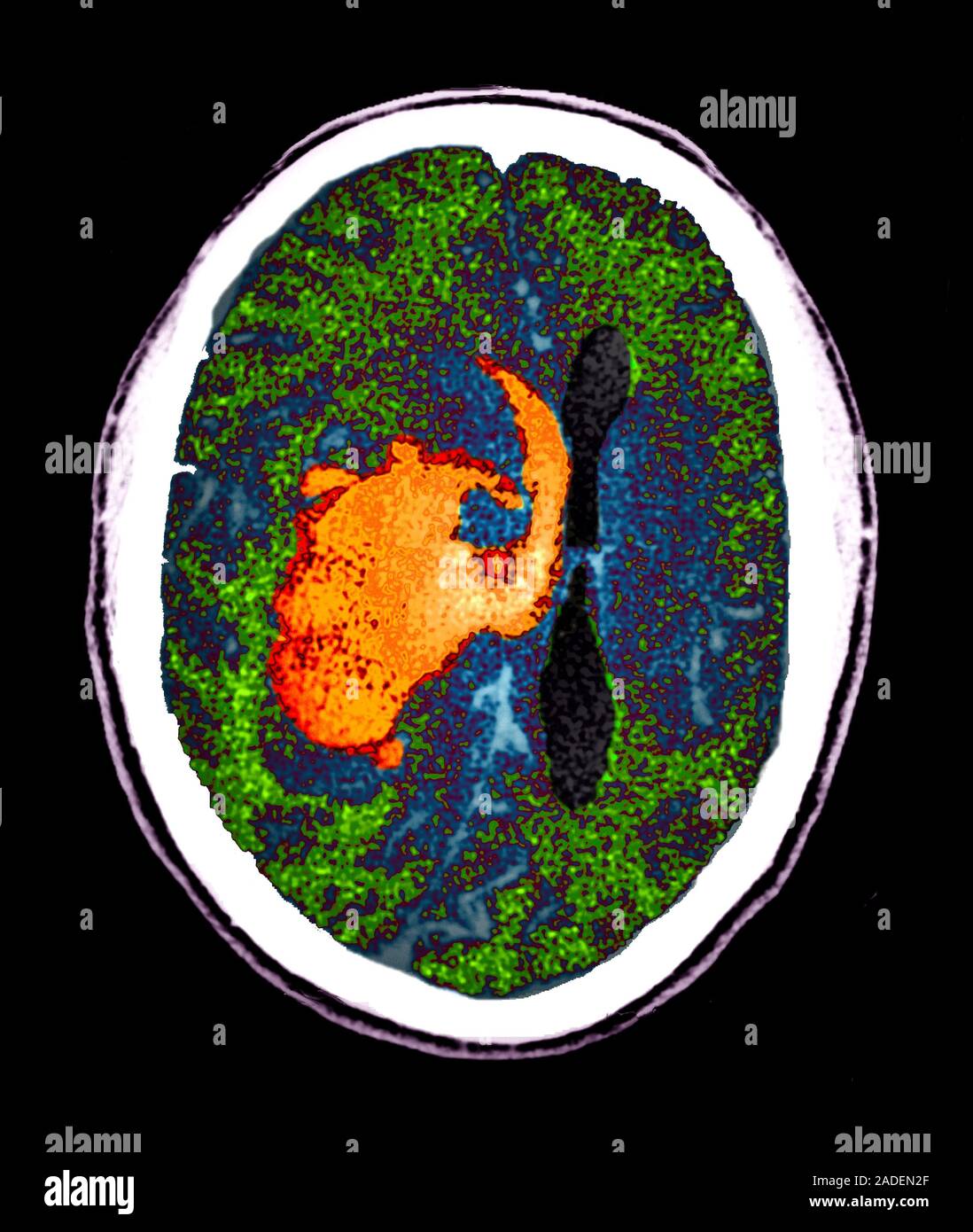 Intraparenchymal haemorrhage (IPH). A coloured computerized tomography (CT) scan of an axial ...