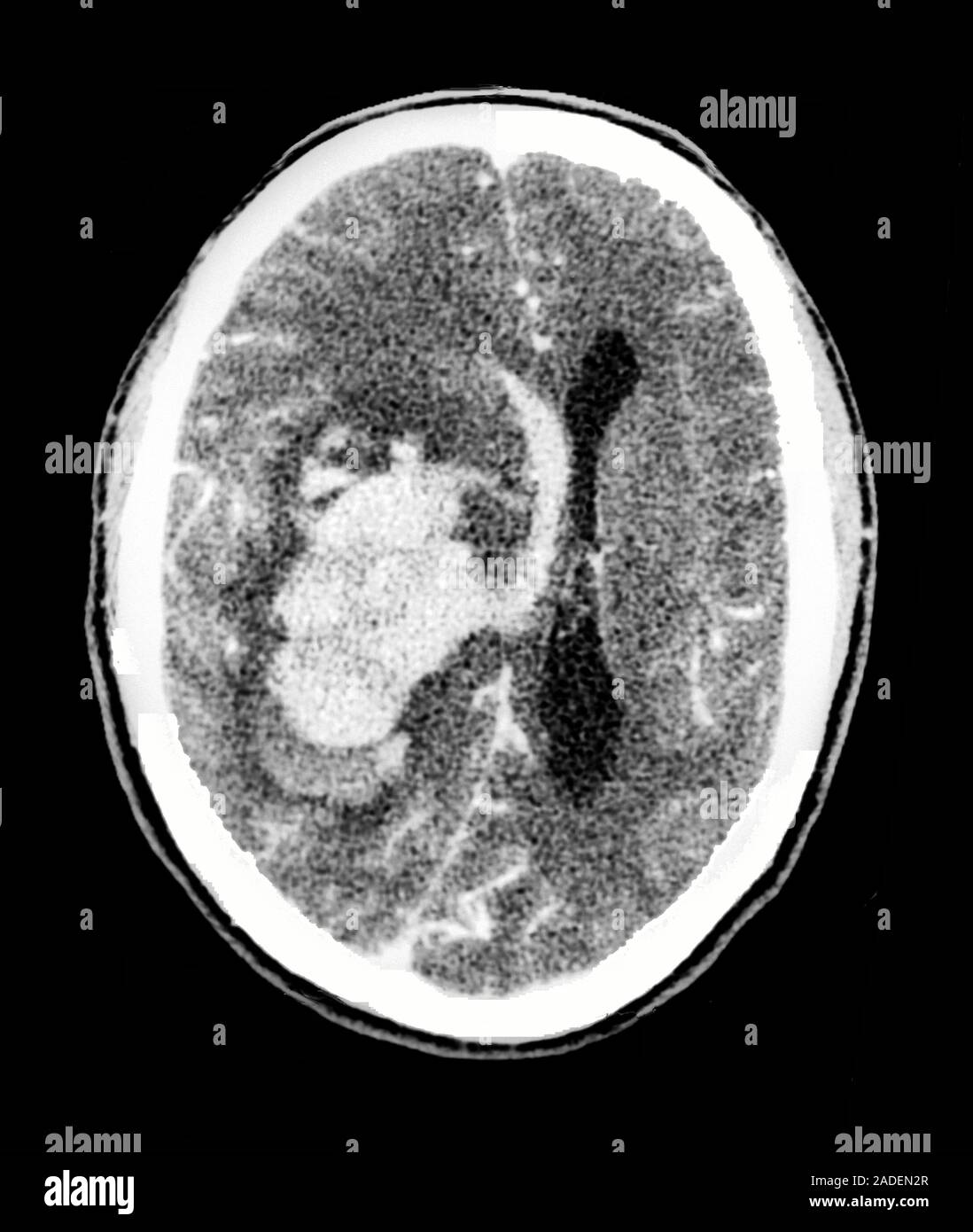 Intraparenchymal haemorrhage (IPH). A computerized tomography (CT) scan ...