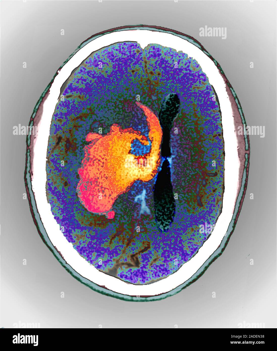 Intraparenchymal haemorrhage (IPH). A coloured computerized tomography (CT) scan of an axial ...
