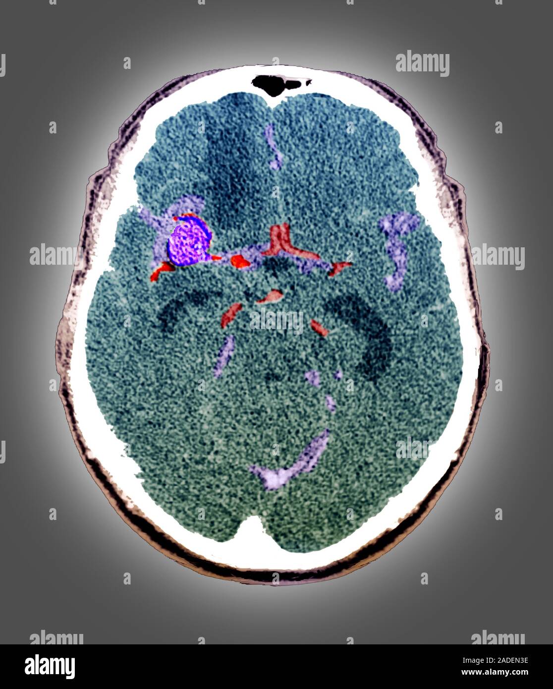Subarachnoid haemorrhage. 2D computerized tomography angiogram (CTA ...