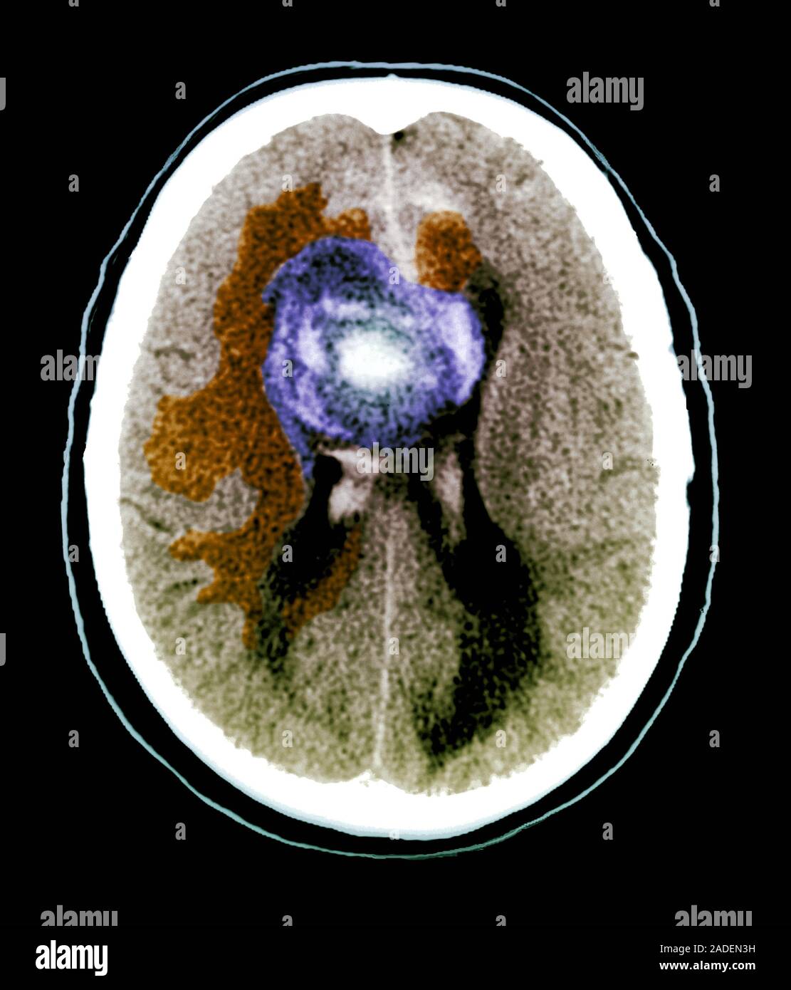 Glioblastoma cancerous brain tumour. A coloured computerized tomography (CT) scan of an axial ...