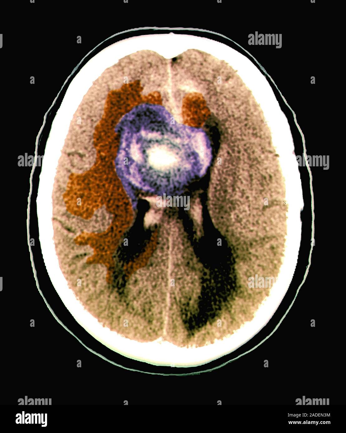 Glioblastoma cancerous brain tumour. A coloured computerized tomography (CT) scan of an axial ...