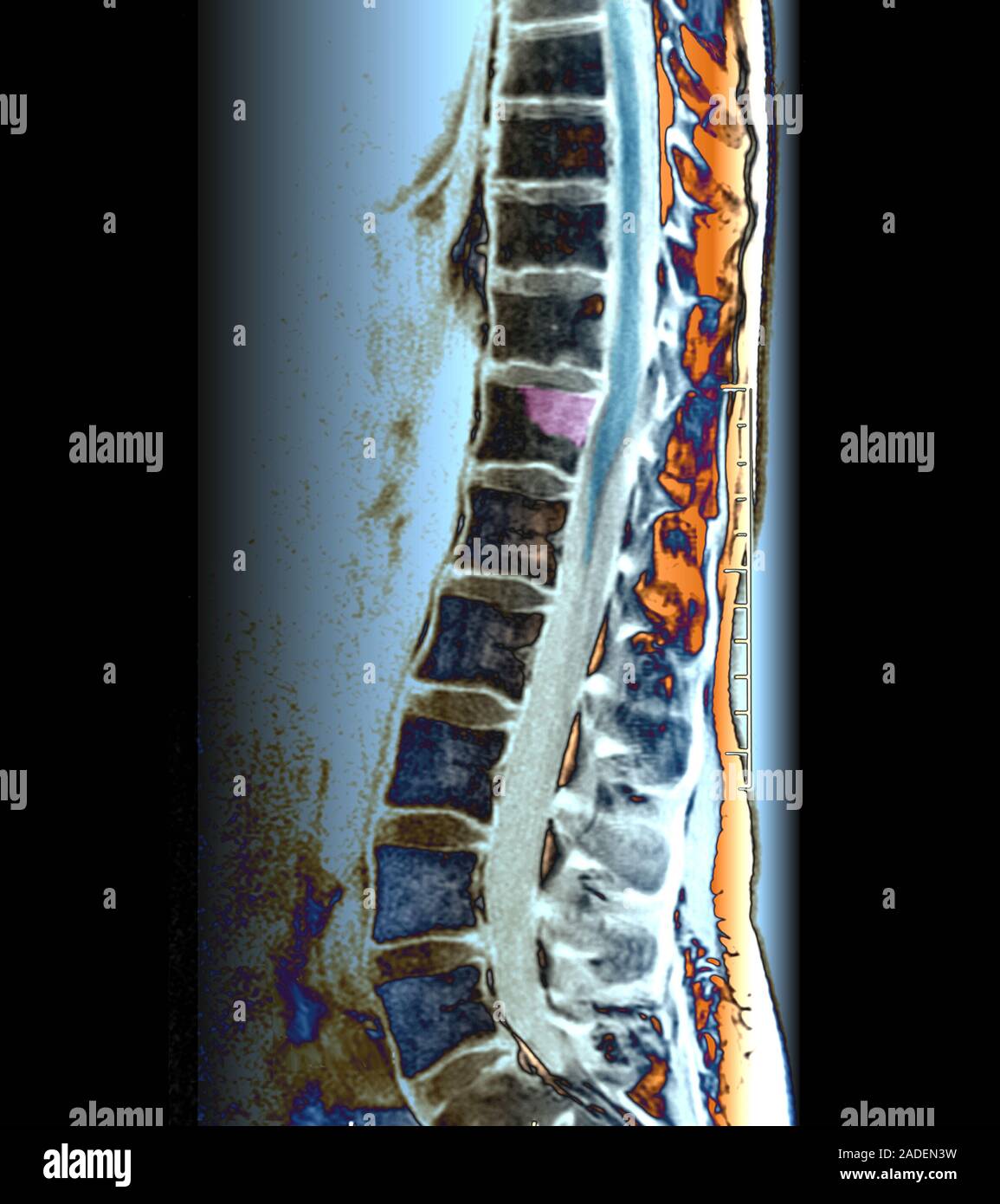 Secondary bone cancer in the spine. Magnetic resonance imaging (MRI ...