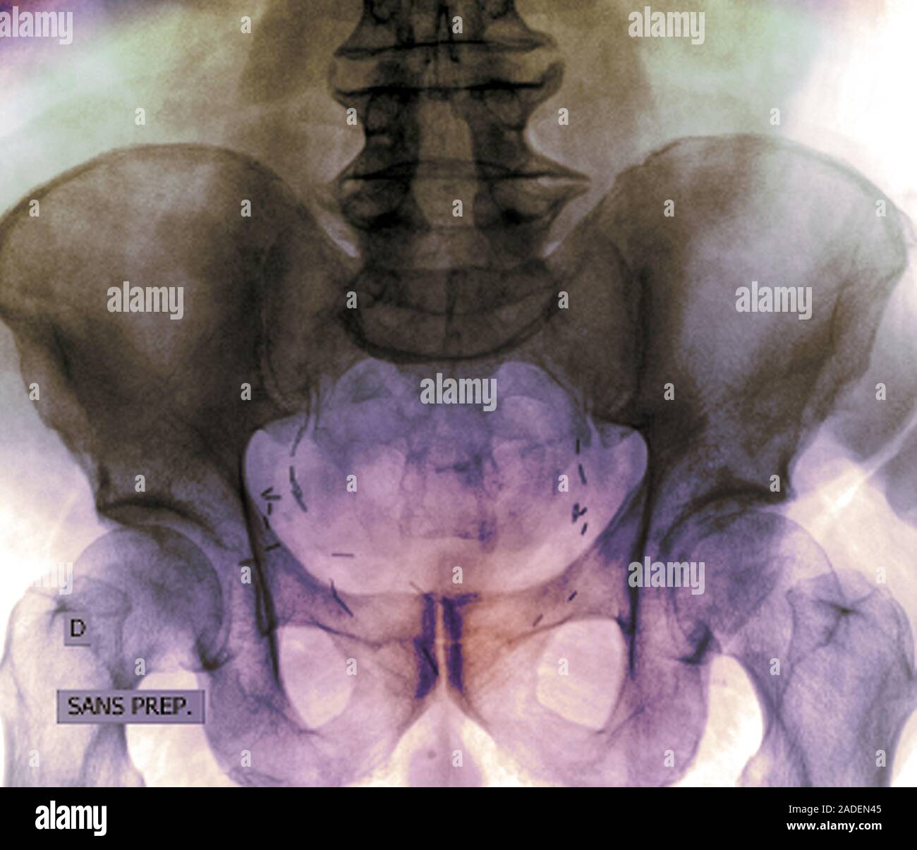 Prostatectomy surgical clips. Coloured X-ray of the pelvic region of a ...