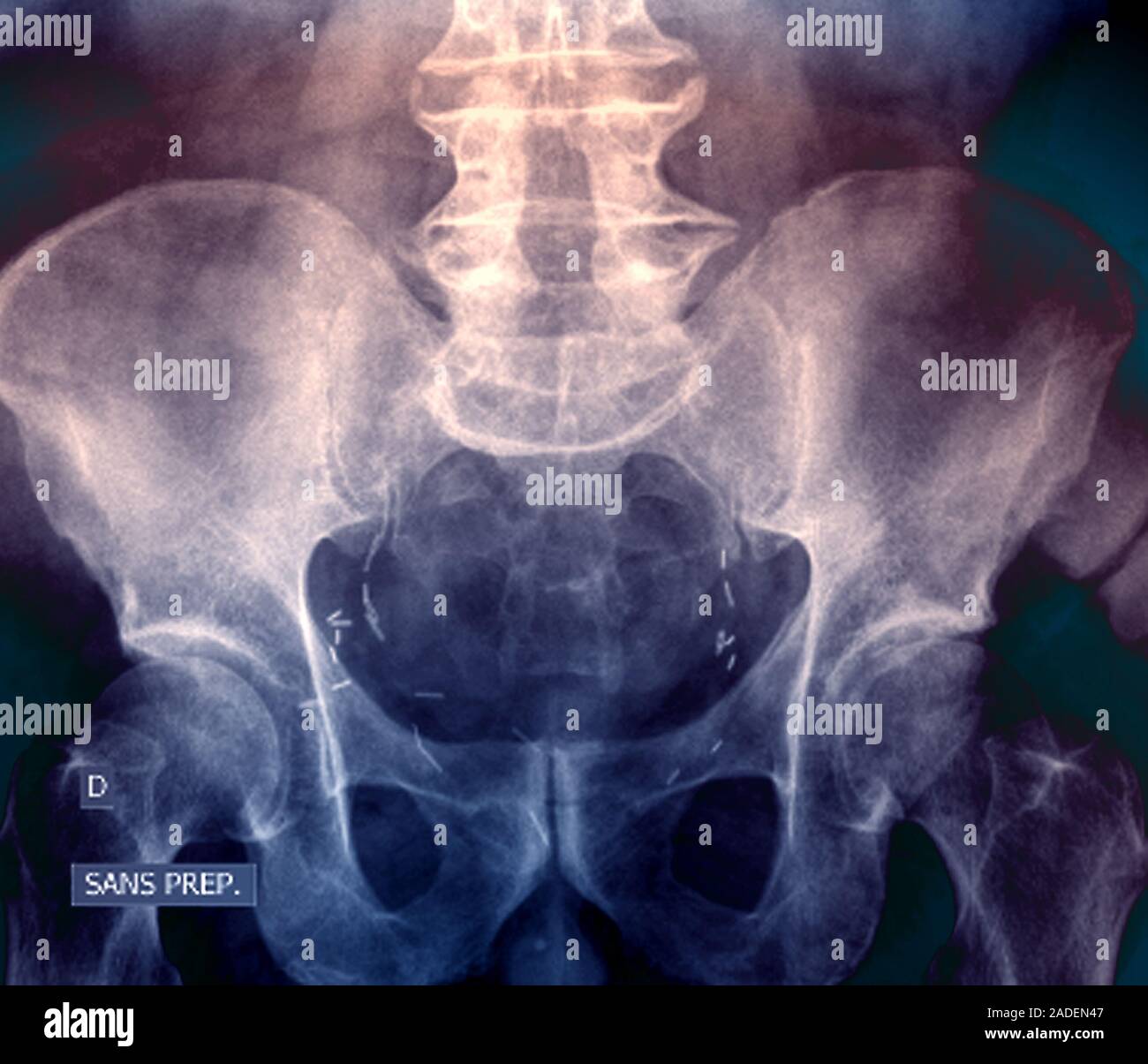 Prostatectomy surgical clips. Coloured X-ray of the pelvic region of a ...