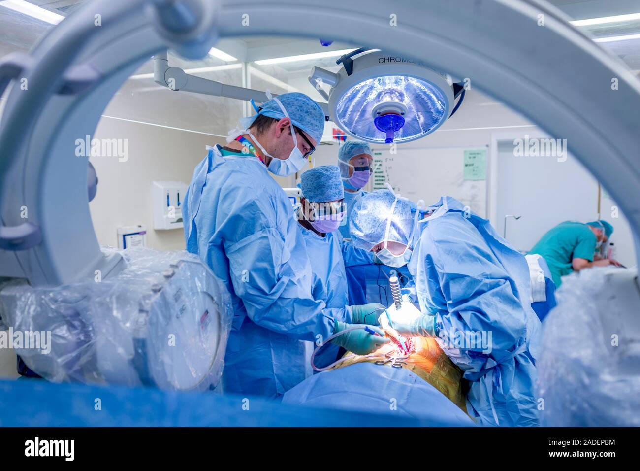 MODEL RELEASED. Spinal surgery. This operation is a revision of ...