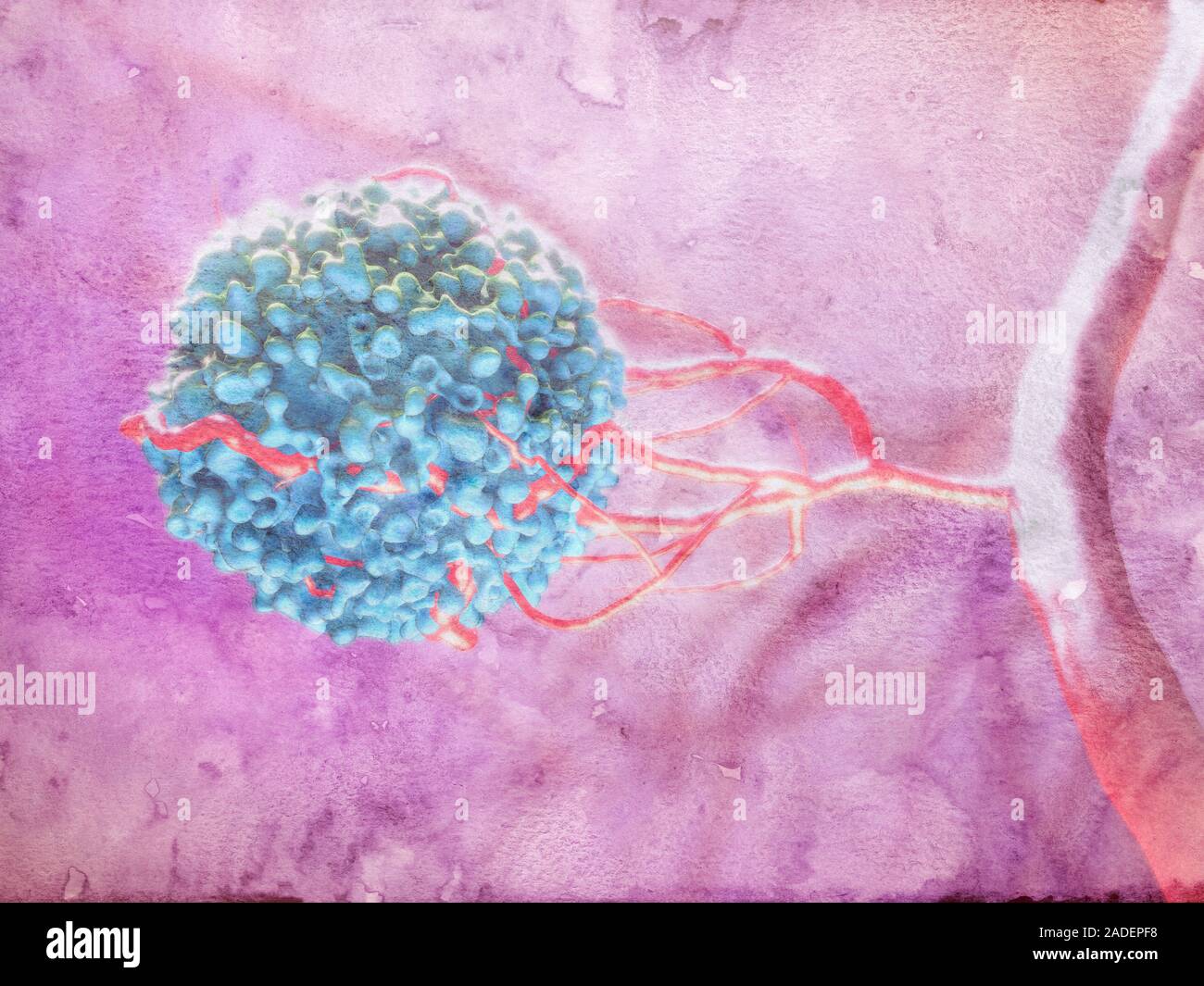 Blood vessel formation. Illustration showing a malignant (cancerous ...