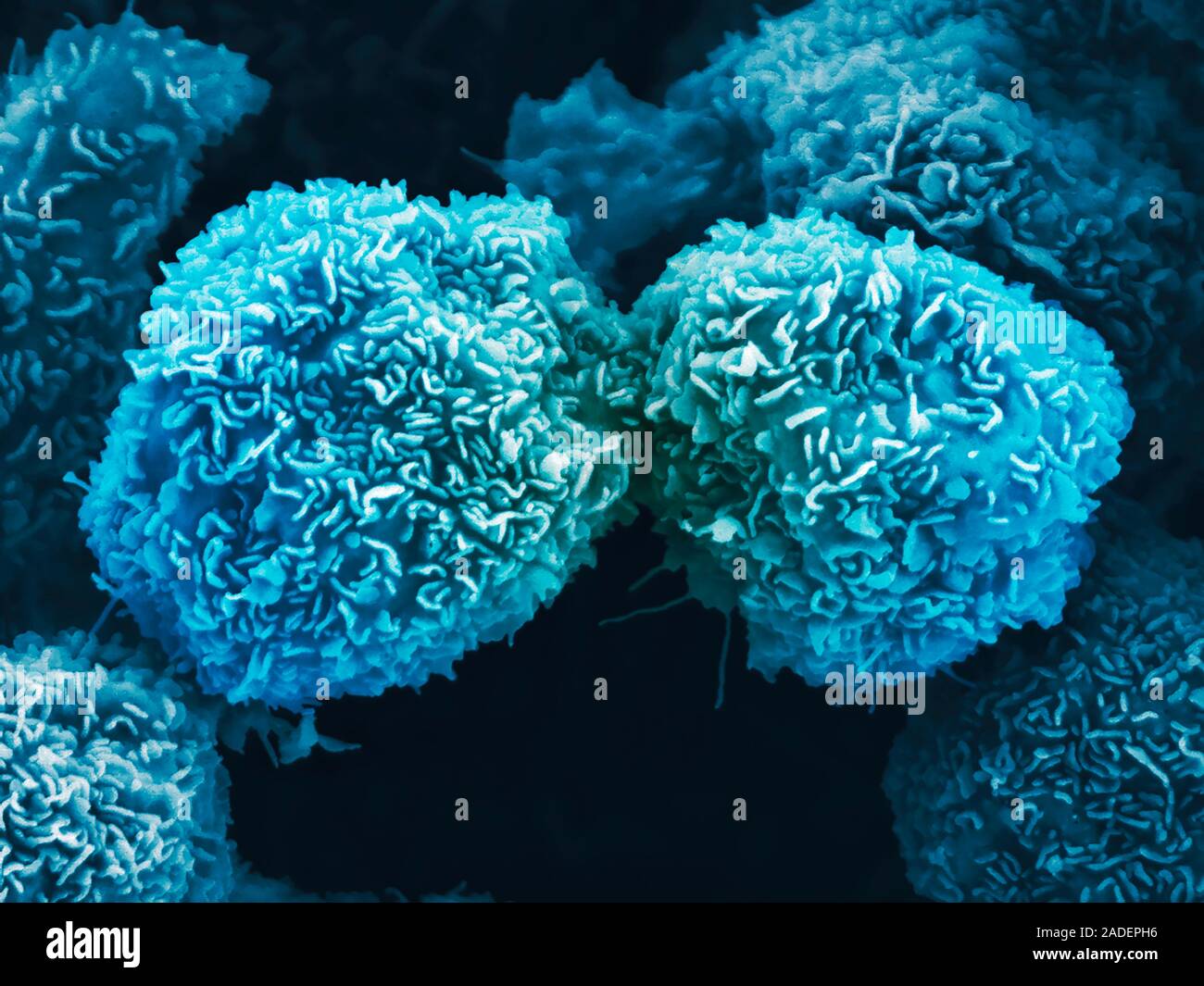 Images not to be used by the tobacco industry. Pancreatic cancer cells ...