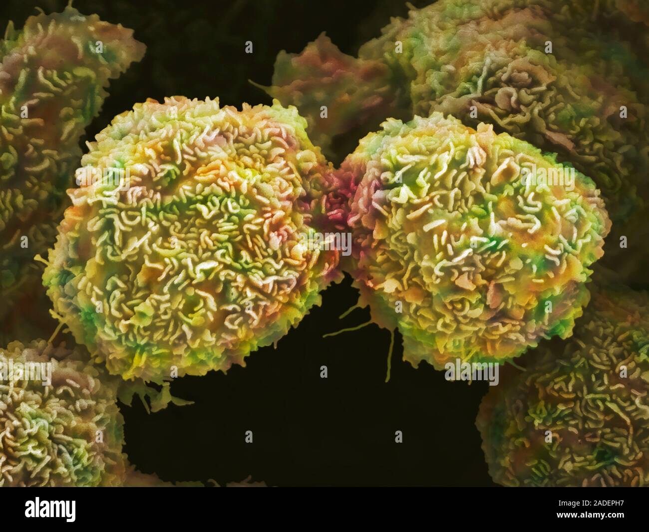 Images not to be used by the tobacco industry. Pancreatic cancer cells ...