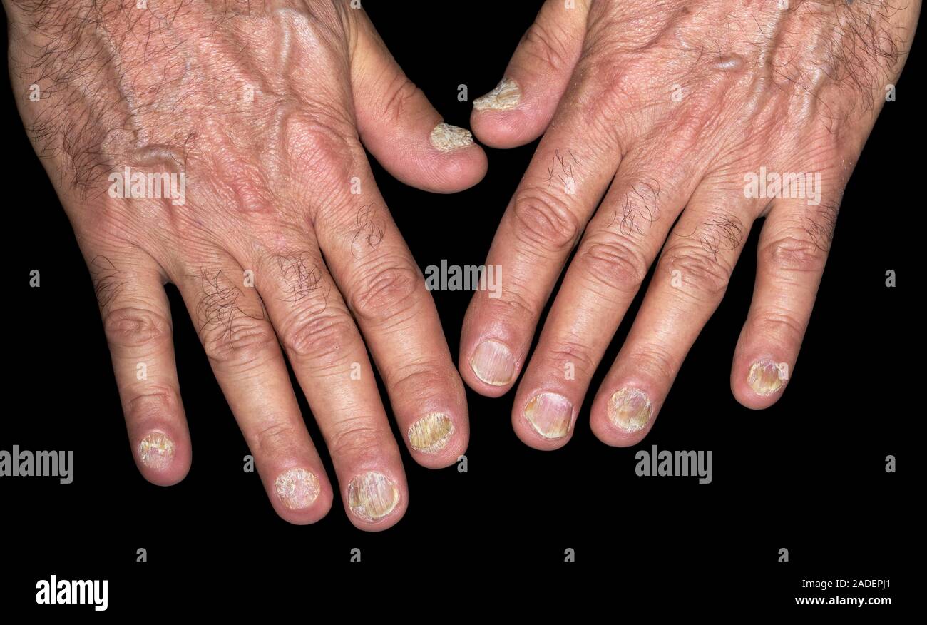 Fungal infection of the fingernails in a middle-aged man. Known as ...