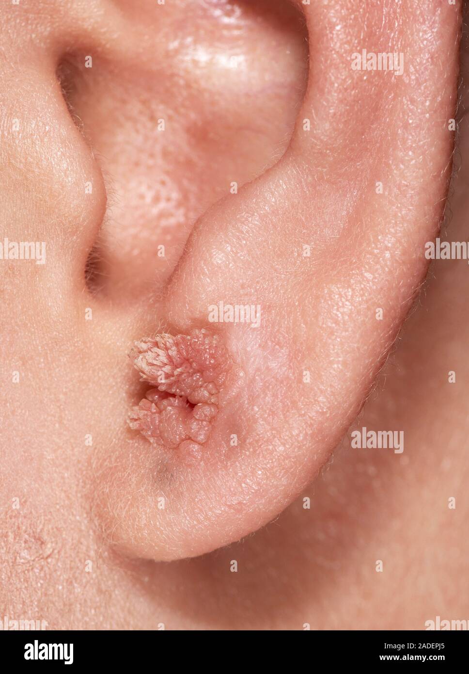 Wart at site of ear piercing. Warts are harmless, contagious growths of ...