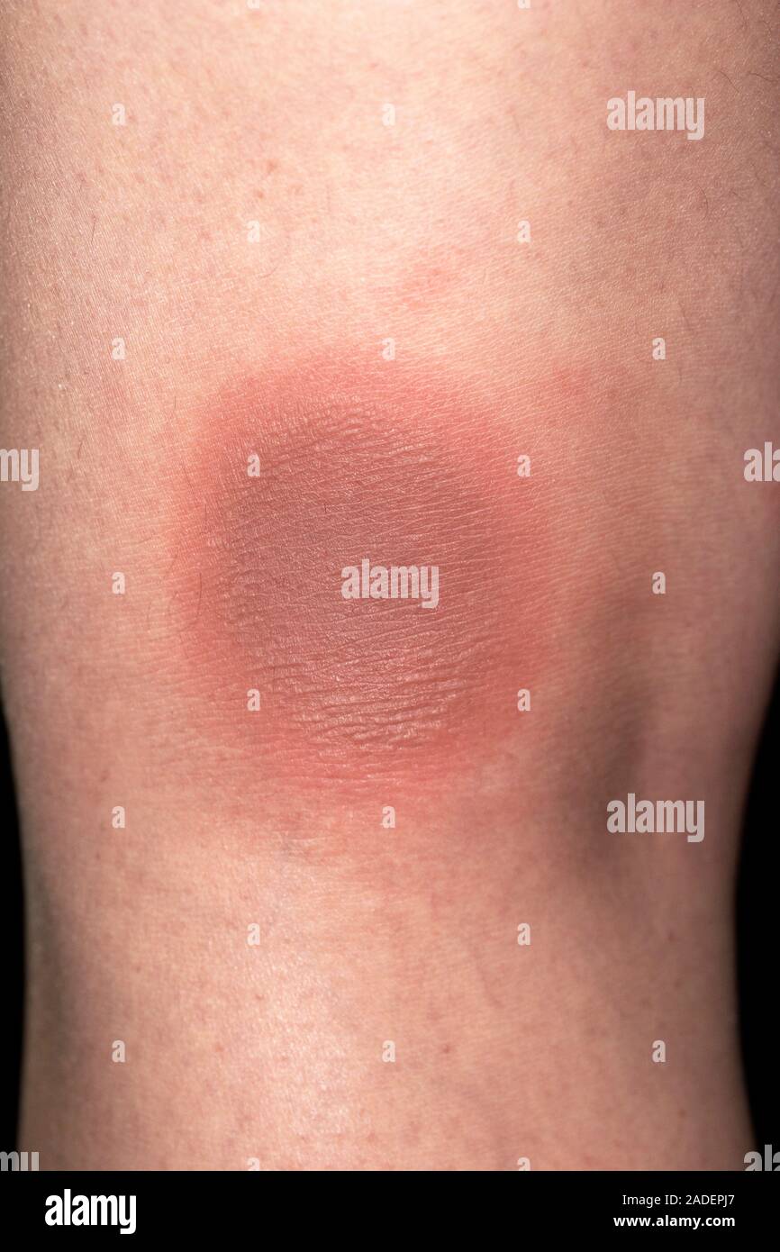 Erythema multiforme rash on the leg of a young male patient following ...