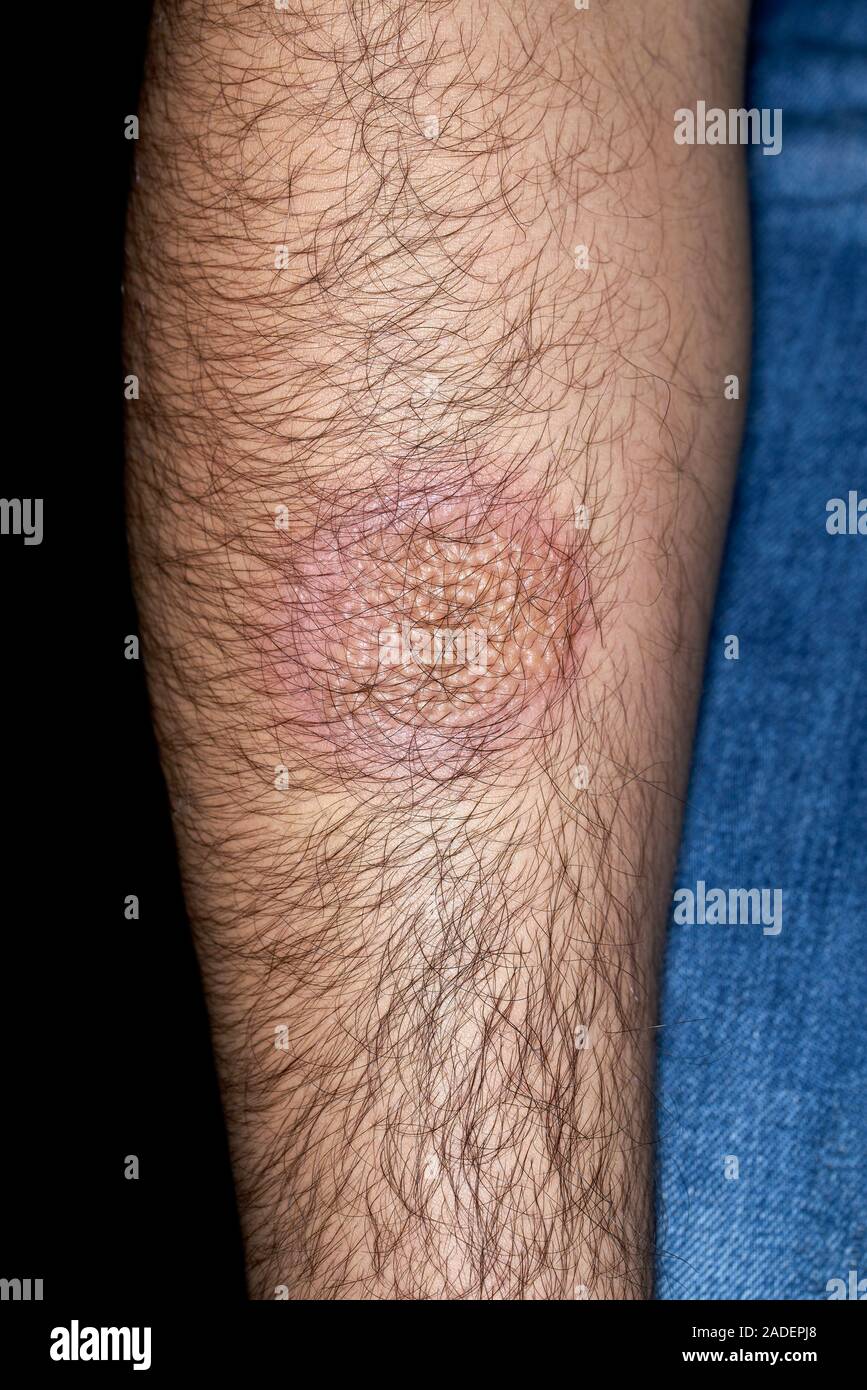 Erythema multiforme rash on the leg of a senior immunocompromised male ...