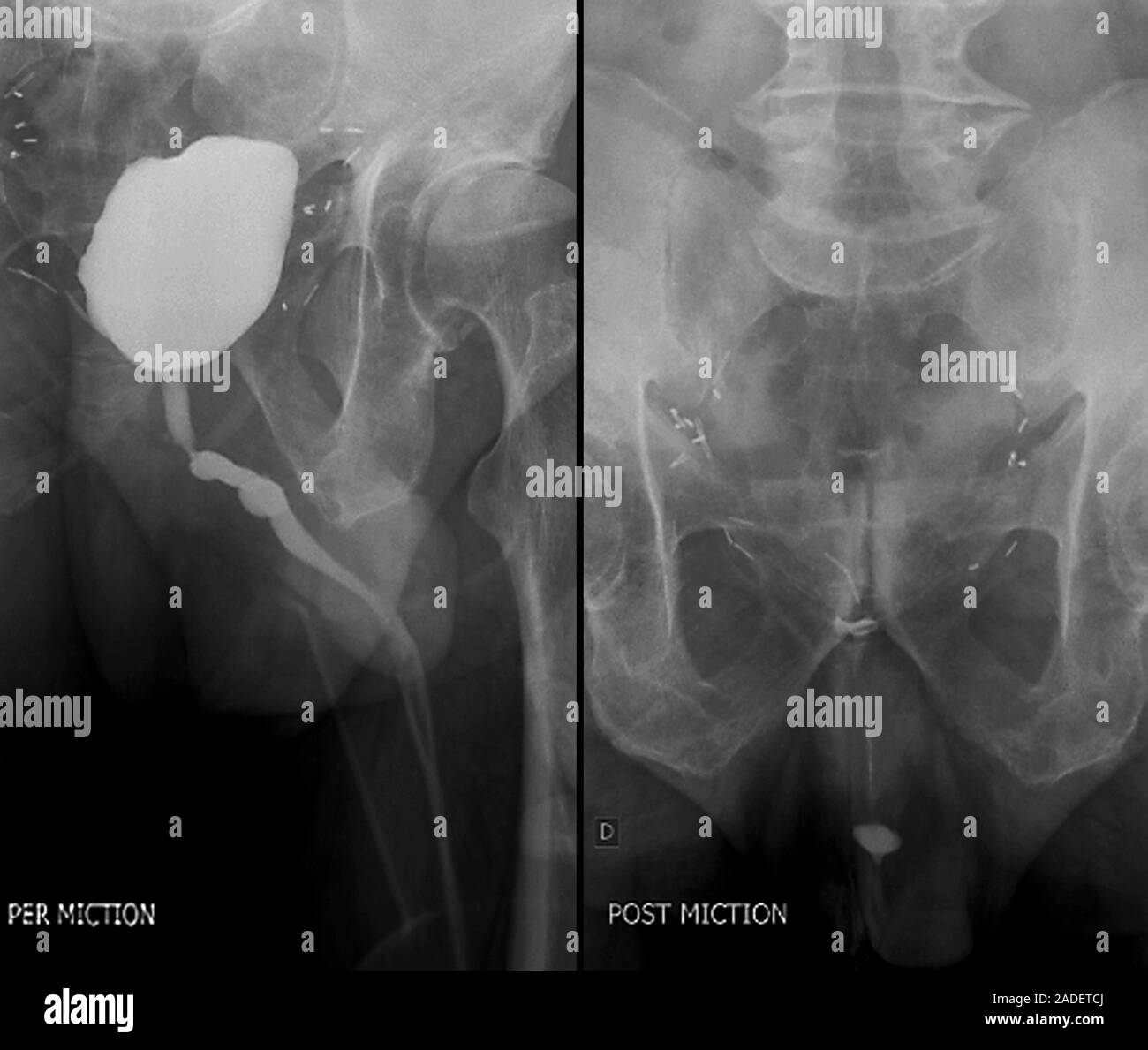 Bladder after prostate removal. X-rays of a section through the pelvis ...